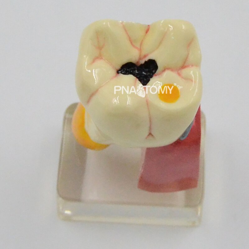 Enlarged Diseased Teeth Model Saprodontia Decayed Tooth Dental Nerve O ...